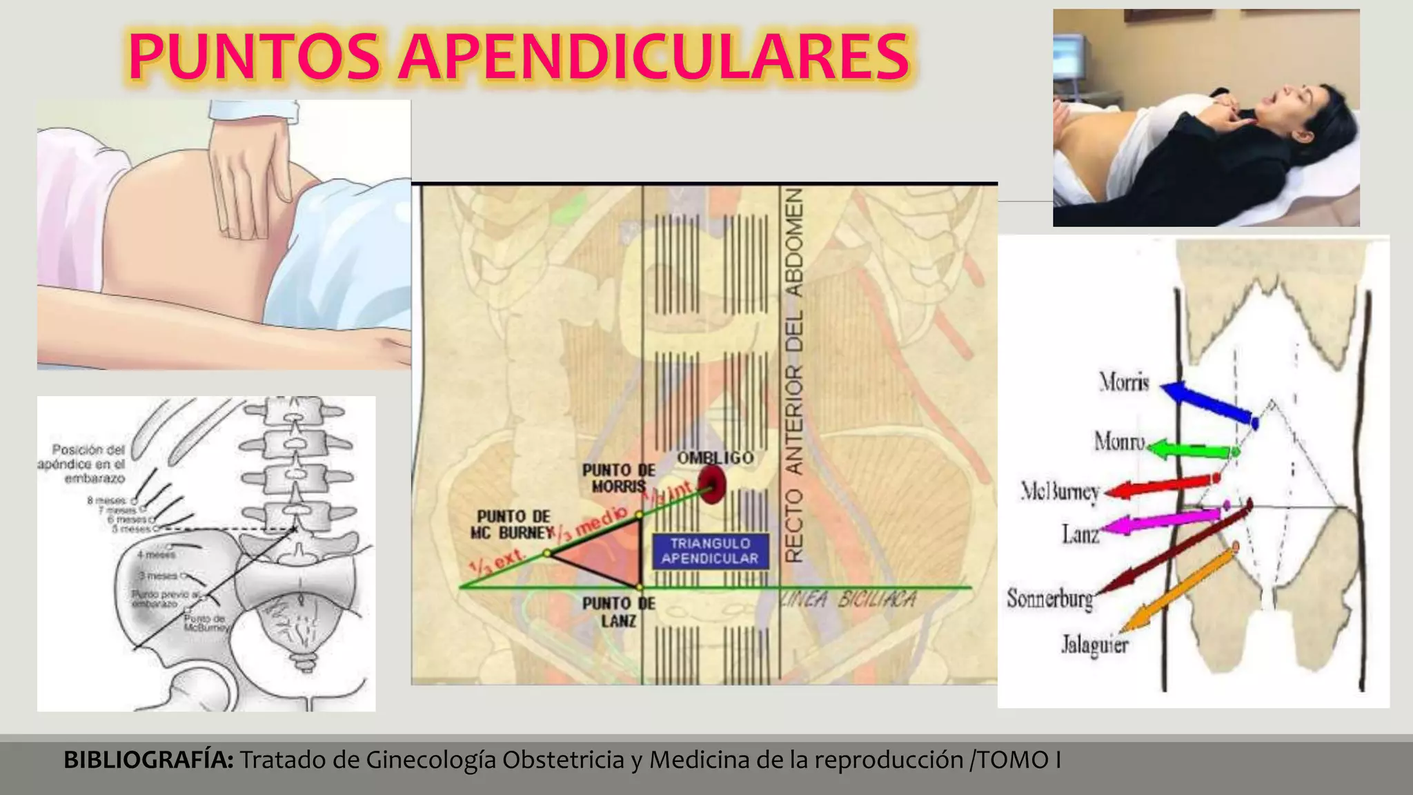 APENDICITIS EN EL EMBARAZO OBSTETRICIA | PPT