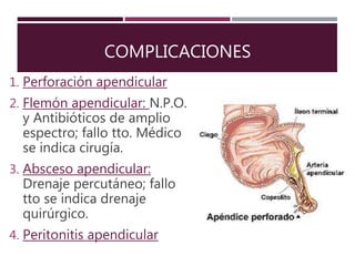 Apendicitis | PPT