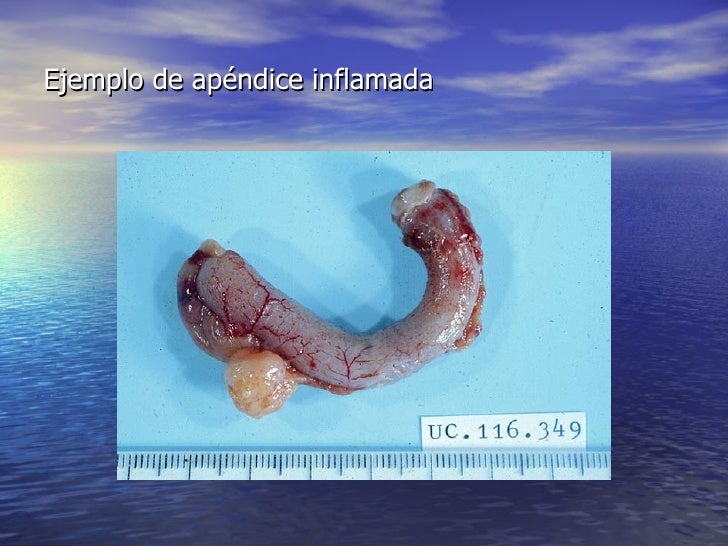 Apendicitis. Maestra Edith