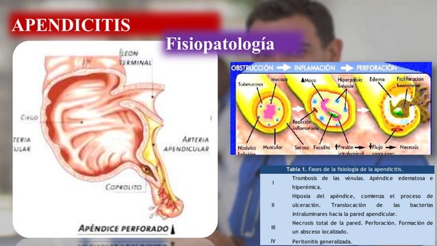Apendicitis Y peritonitis APENDICULAR