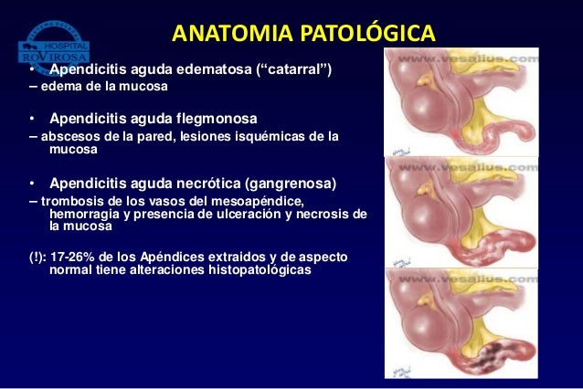 Apendicitis aguda.