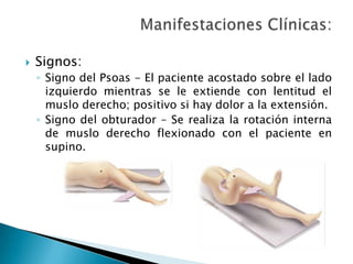 Apendicitis aguda | PPTX