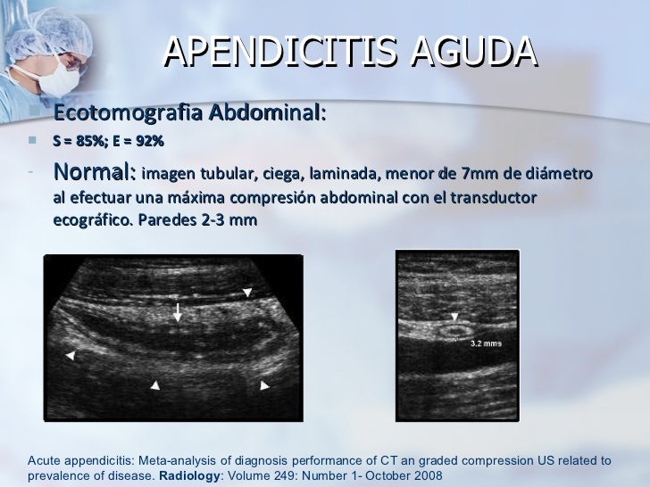 Apendicitis aguda