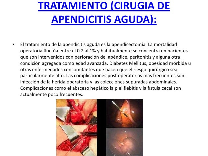 Peritonitis Aguda