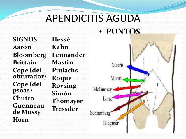 Apendicitis aguda