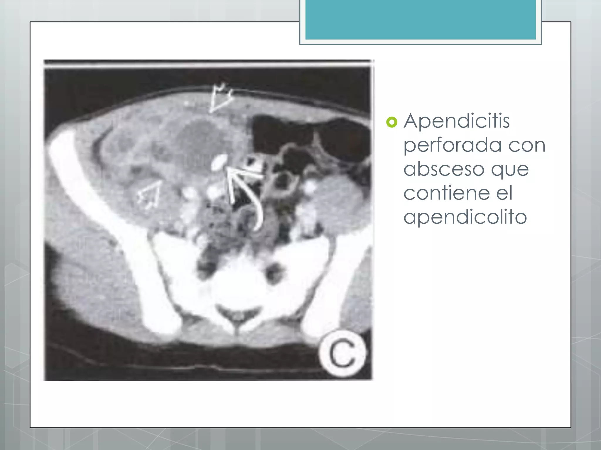 Apendicitis aguda Radiologia | PPT