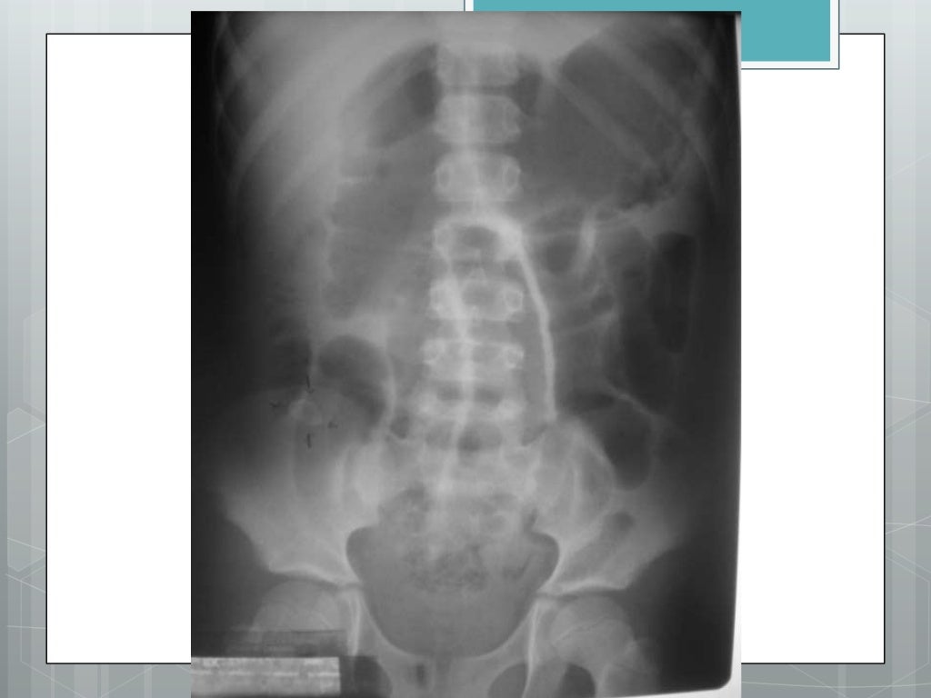 Raio X Abdome Apendicite - RETOEDU