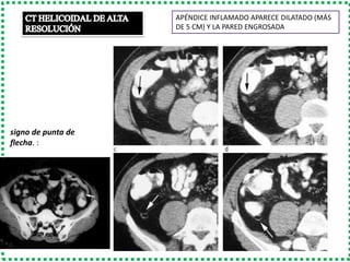 APENDICITIS AGUDA | PPTX