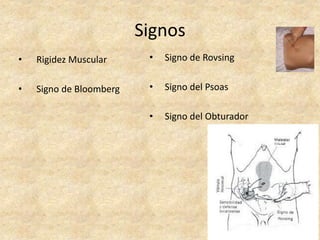 Apendicitis aguda | PPTX