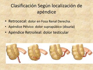 Apendicitis aguda | PPT