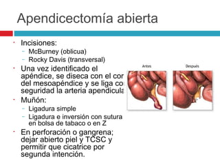Apendicitis aguda | PPT