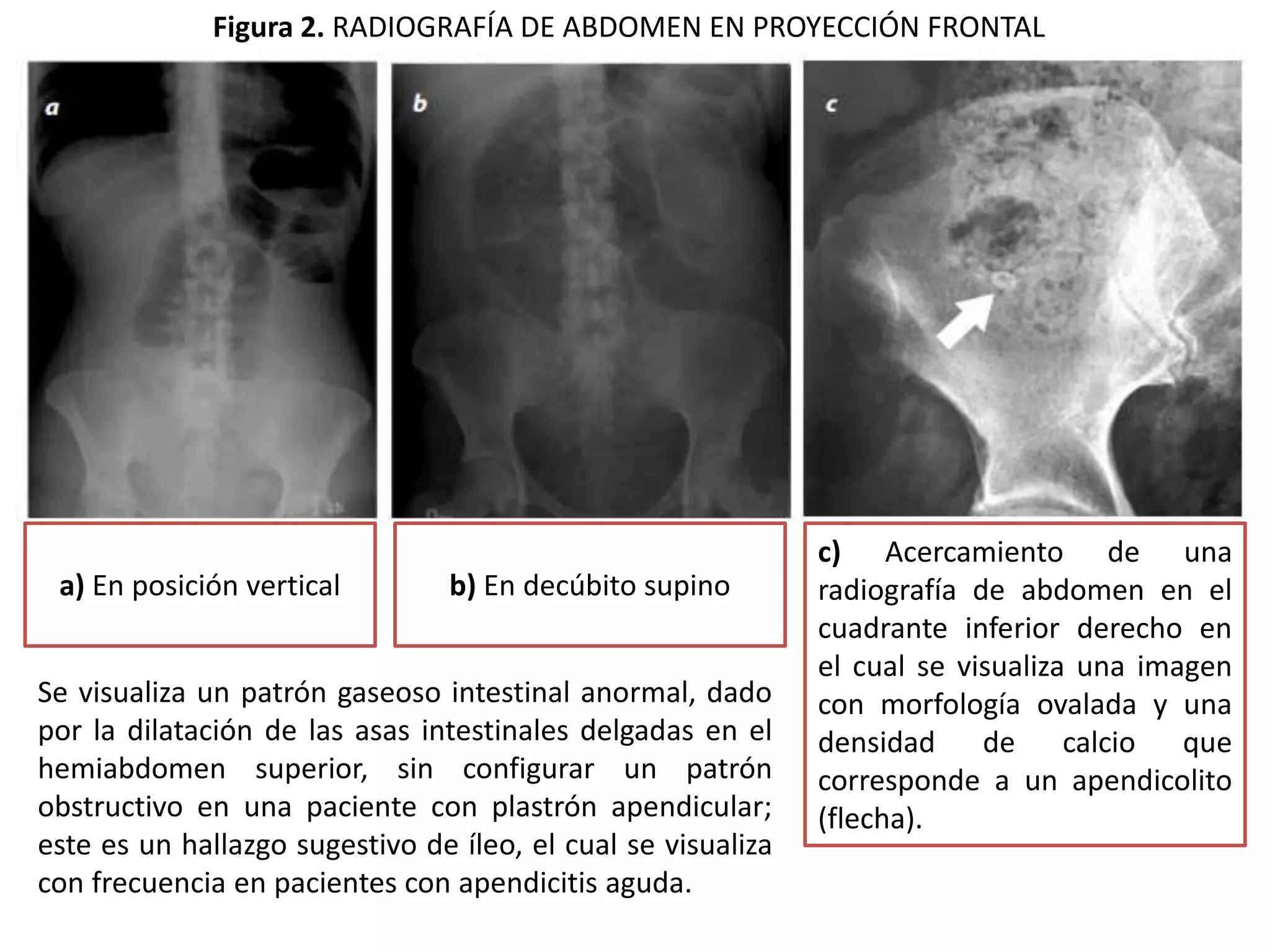 Apendicitis aguda en Radiologia | PPTX