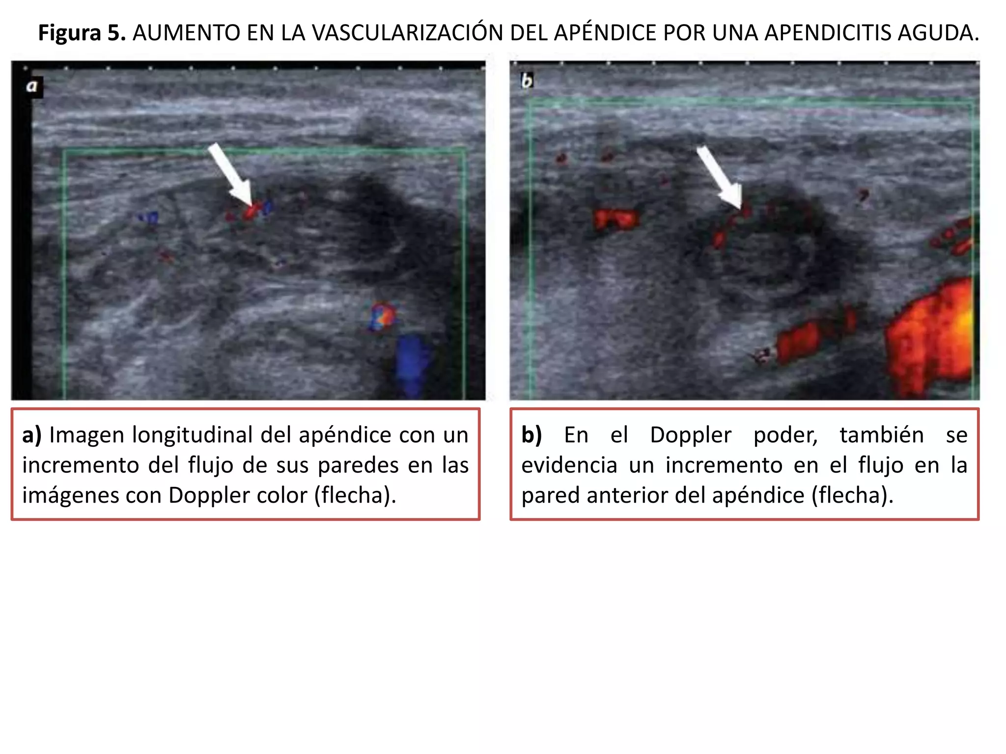 Apendicitis aguda en Radiologia | PPTX