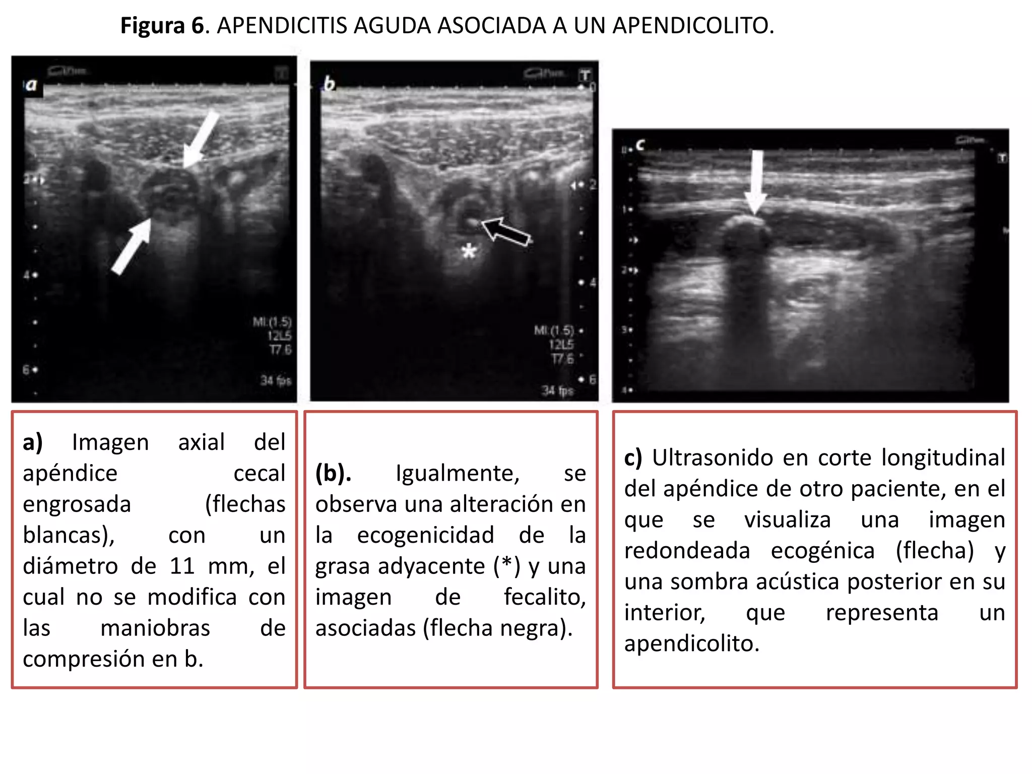 Apendicitis aguda en Radiologia | PPTX