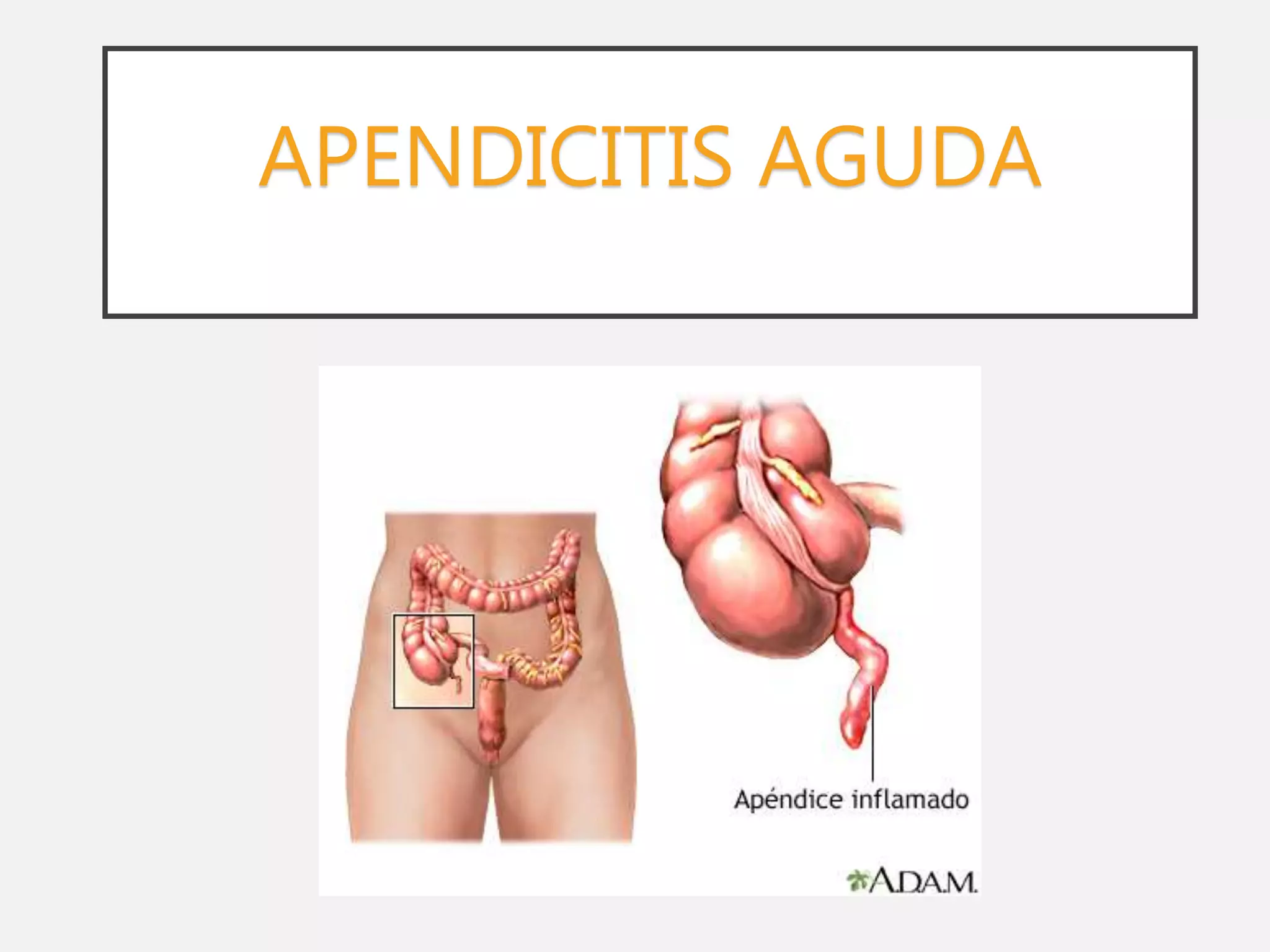 Apendicitis aguda | PPT