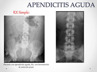 Apendicitis aguda | PPT