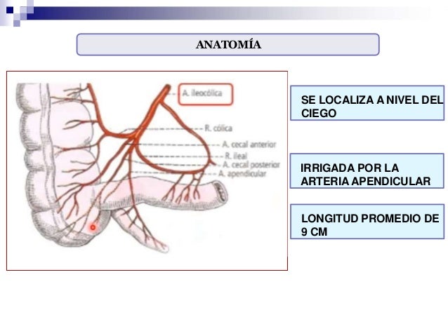 Apendicitis aguda