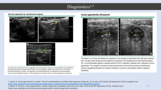 Apendicitis aguda | PPTX