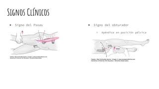 Apendicitis aguda, Caso clínico y Revisión de tema. | PDF