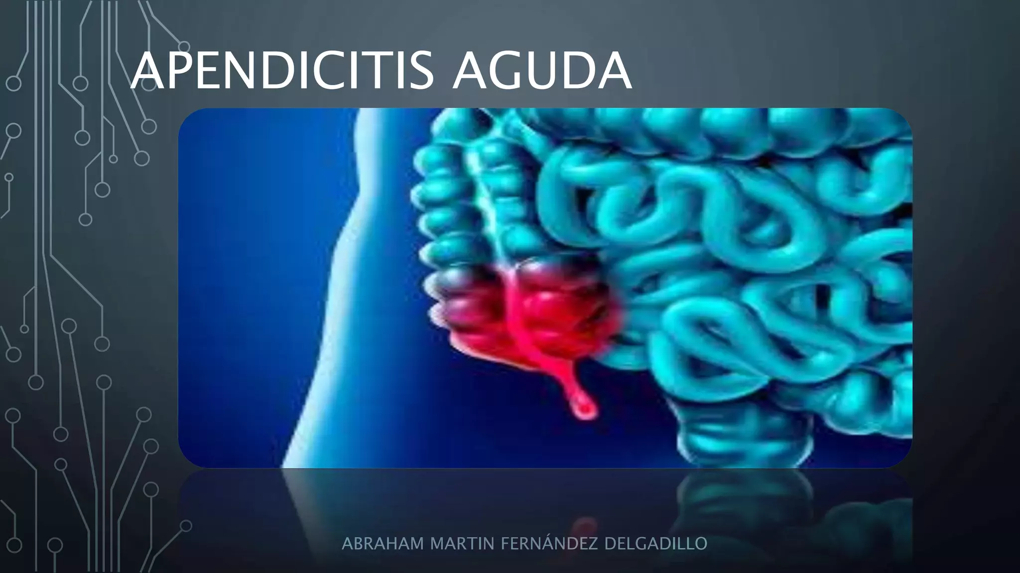 Apendicitis aguda | PPT