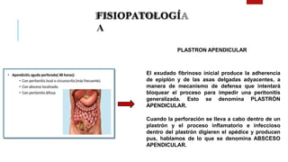 apendicitis aguda.pptx