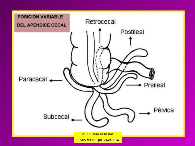 APENDICITIS AGUDA ANATOMIA Y CIRUGIA LAPATOSCOPICA | PPTX