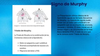 APENDICITIS AGUDA ROTACION DE CIRUGIA UCATECI | PPTX