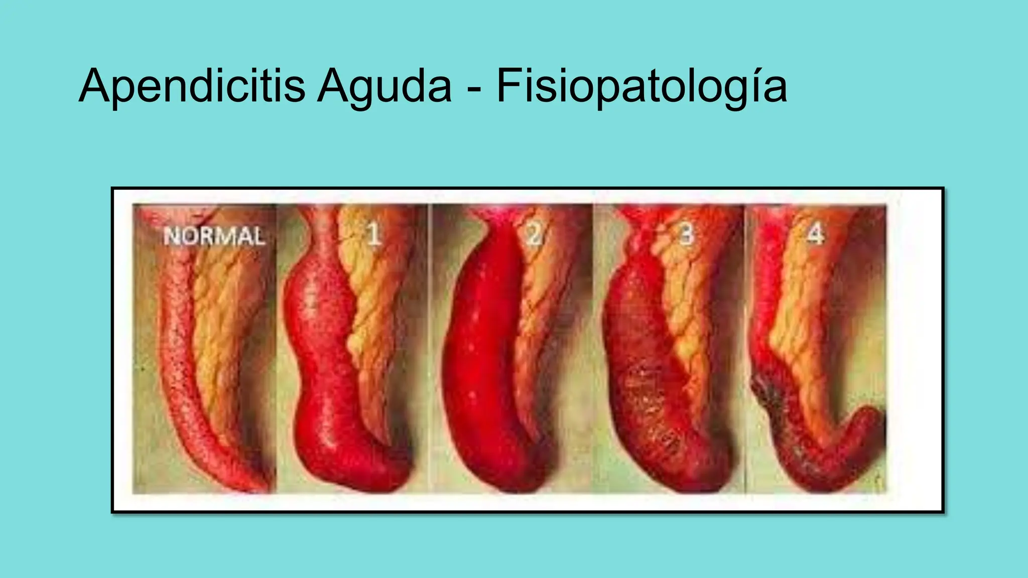 APENDICITIS AGUDA ANATOMÍA, TÉCNICA QUIRÚRGICA.pptx