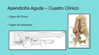 APENDICITIS AGUDA ANATOMÍA, TÉCNICA QUIRÚRGICA.pptx