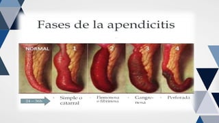 Apendicitis Aguda,clasificacion, diagnostico y tratamiento.pptx