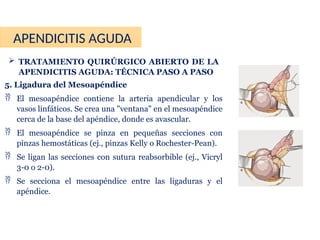 APENDICITIS AGUDA.pptx concepto, etología, fases , fisiopatología | PPTX
