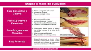 apendicitis aguda | PPT