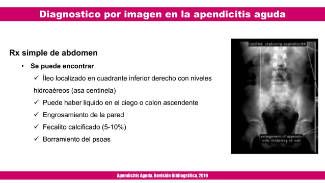 Apendicitis aguda final | PPTX