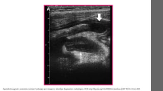 Apendicitis aguda - Imagen.pptx