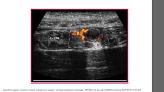 Apendicitis aguda - Imagen.pptx