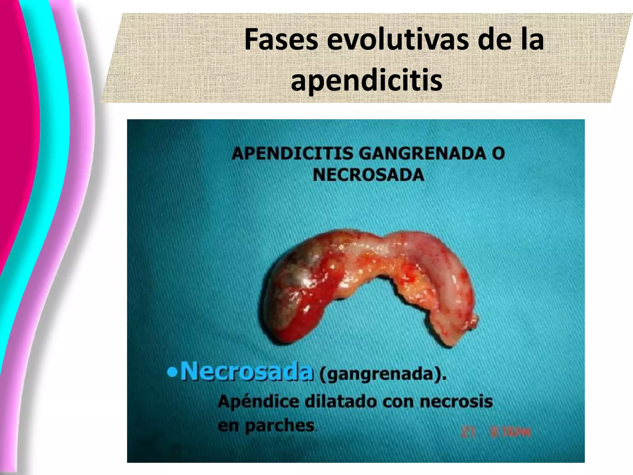 Apendicitis aguda