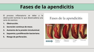 APENDICITIS AGUDA - MARISSA RAMOS (1).pptx