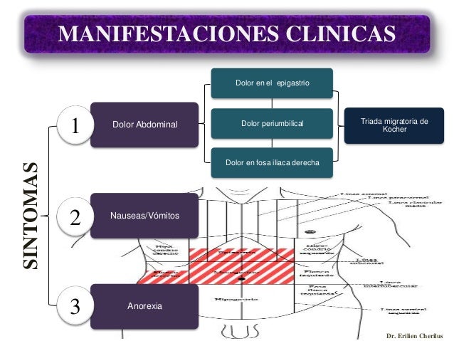 Apendicitis aguda - Cirugia General