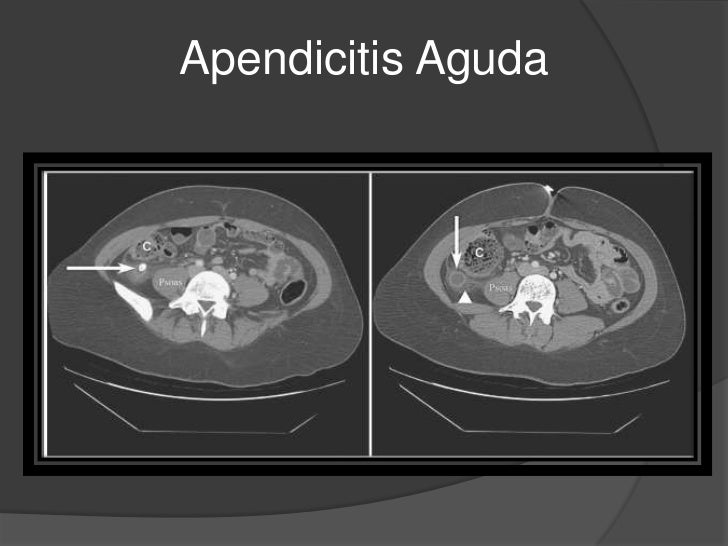 Apendicitis Aguda.Sem