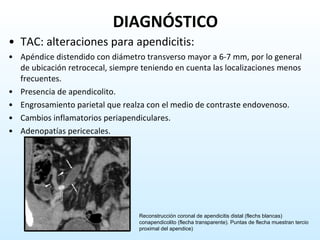 Apendicitis Aguda 0809 | PPT
