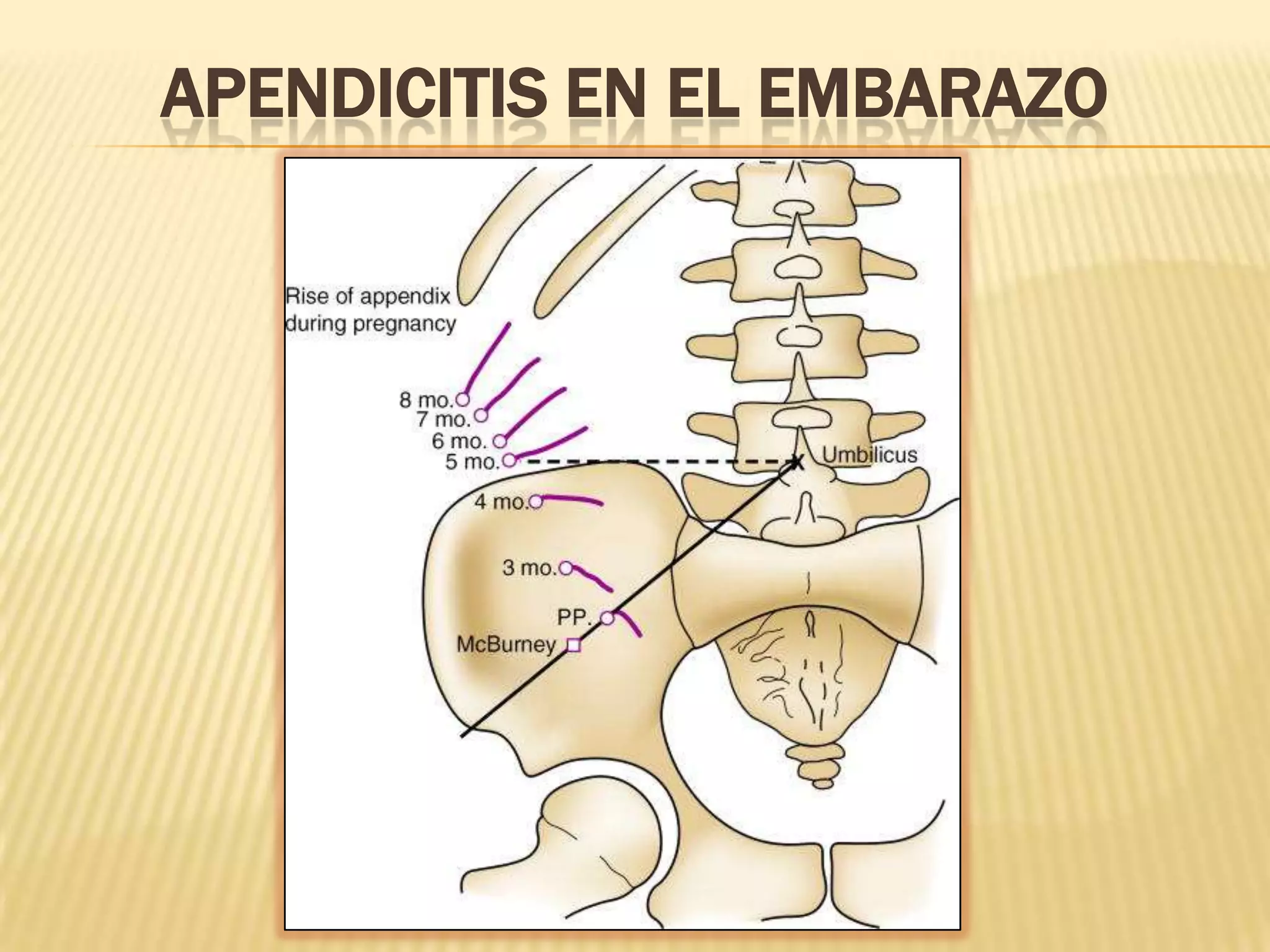 Apendicitis aguda cjmt | PPTX