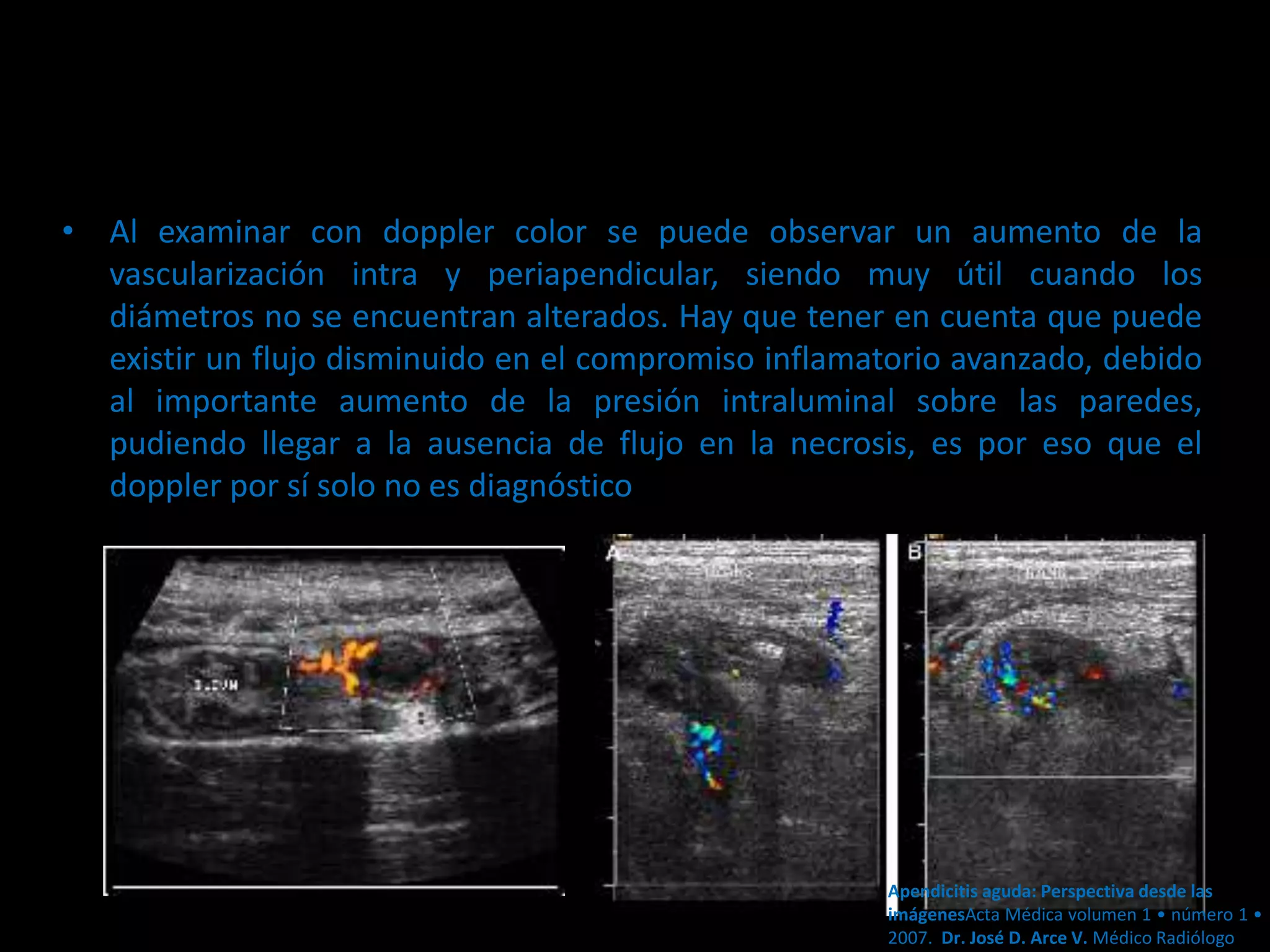 Apendicitis aguda diverticulo meckel | PPT