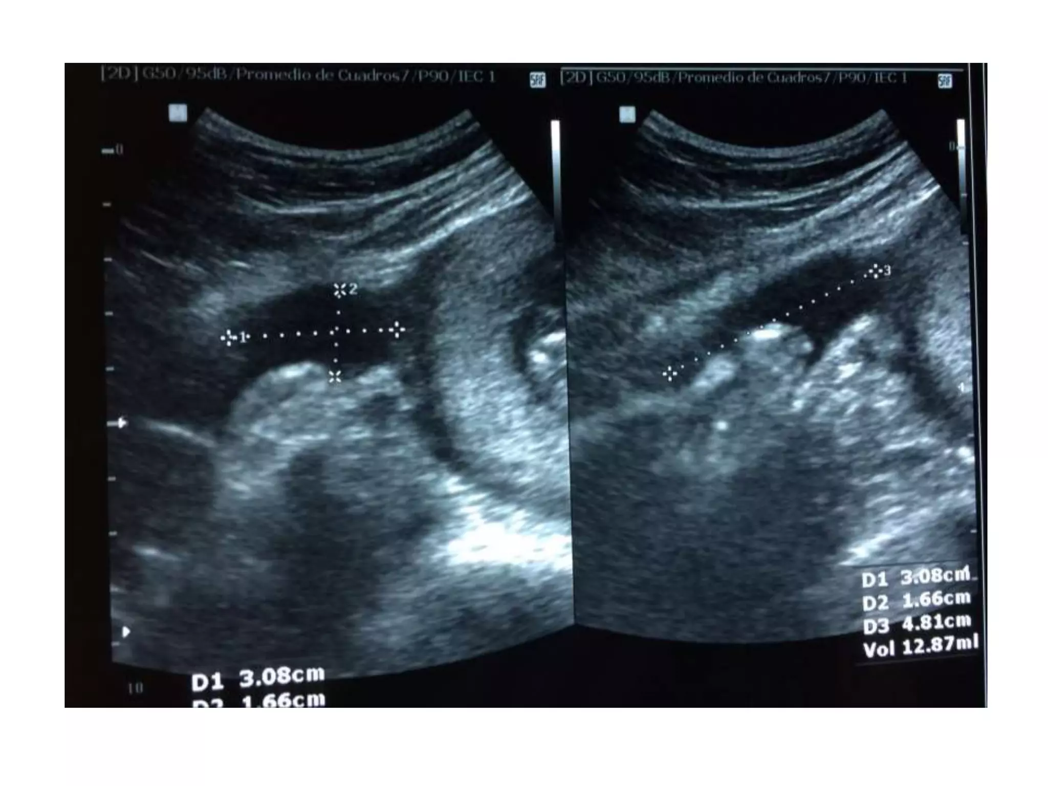 Apendicitis aguda en el embarazo | PPTX | Pregnancy | Reproductive Health