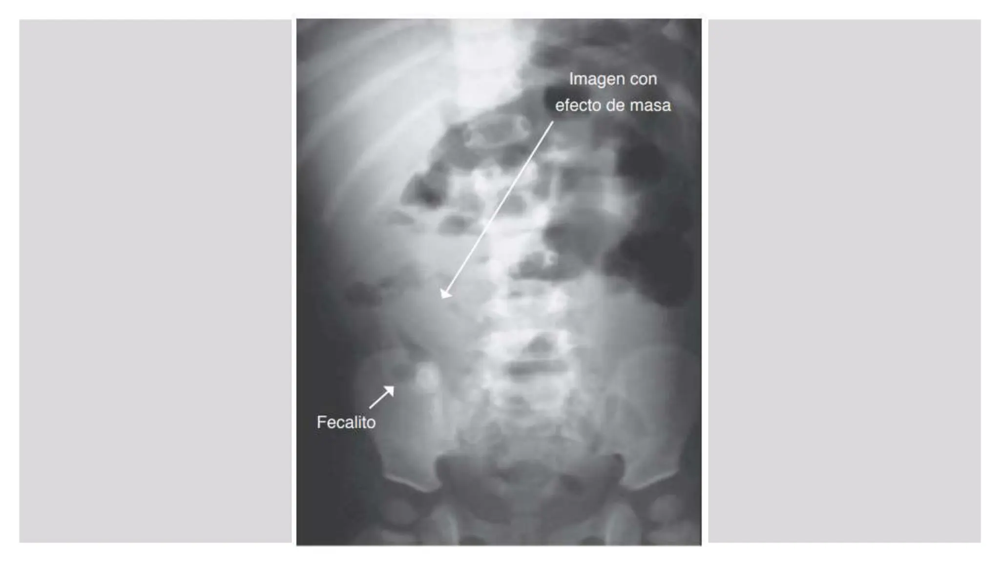 Apendicitis aguda en pediatría residentes.pptx