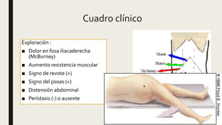 Apendicitis aguda en pediatria | PPTX