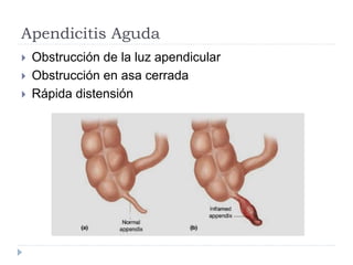 Apendicitis aguda | PPTX