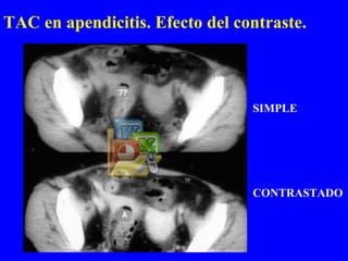 Apendicitis Aguda | PPT