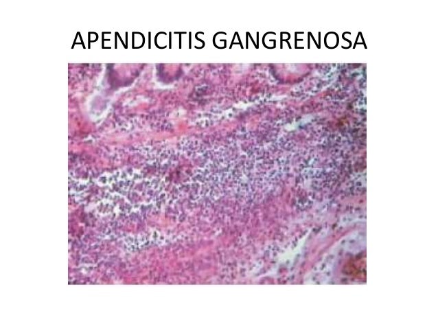 Apendicitis aguda laboratrio