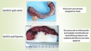 Apendicitis aguda, Obstrucción intestinal en el embarazo. (1) (1).pptx
