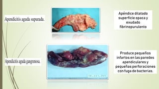 Apendicitis aguda, Obstrucción intestinal en el embarazo. (1) (1).pptx